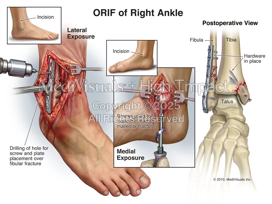 ORIF of Right Ankle | MediVisuals + High Impact