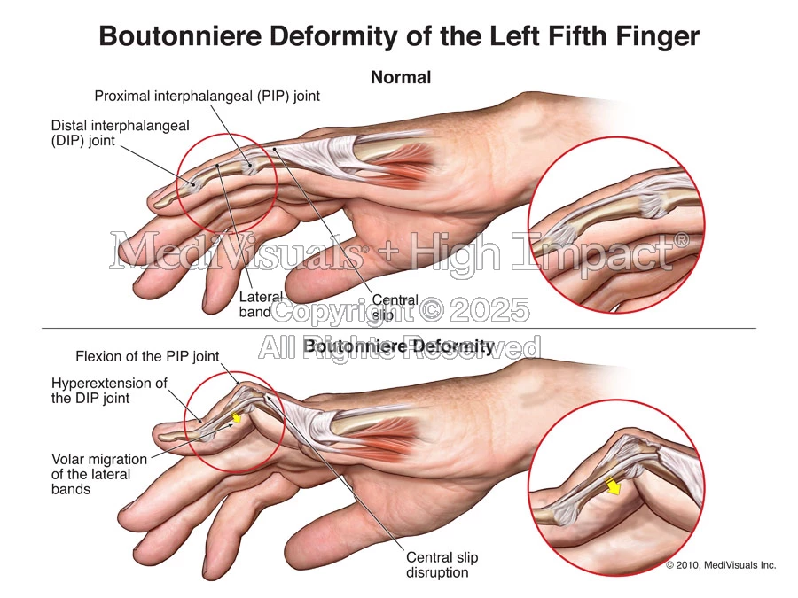 Boutonniere Deformity of the Left Fifth Finger | MediVisuals + High Impact
