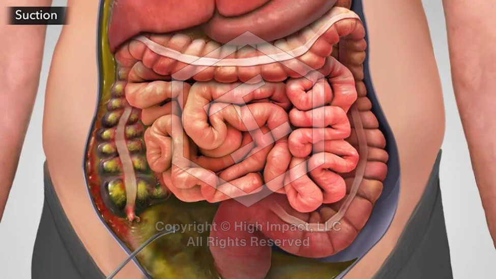 7-Figure Settlement: Animated Appendix Rupture After Botched ...