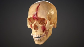 Demonstrative of Skull and Brain Injuries | MediVisuals + High Impact